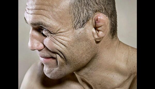 Como prevenir la famosa Oreja de Coliflor por el Doctor de Medicina del ...